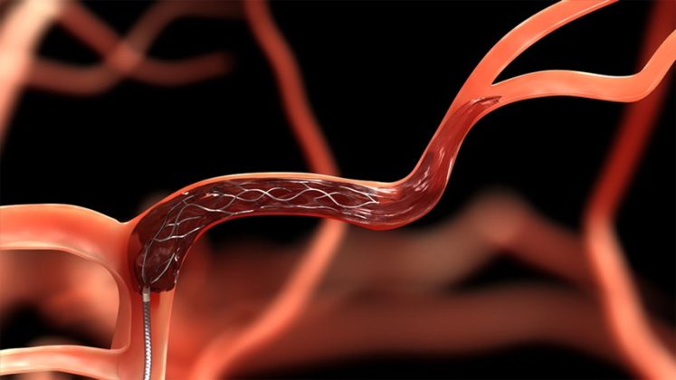 New clot retrieval device greatly improves stroke outcomes | Star Mag