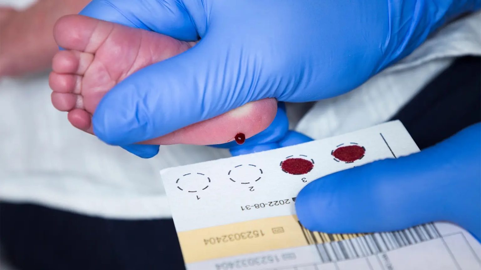 Newborn screening for cystic fibrosis benefits adult height | Star Mag